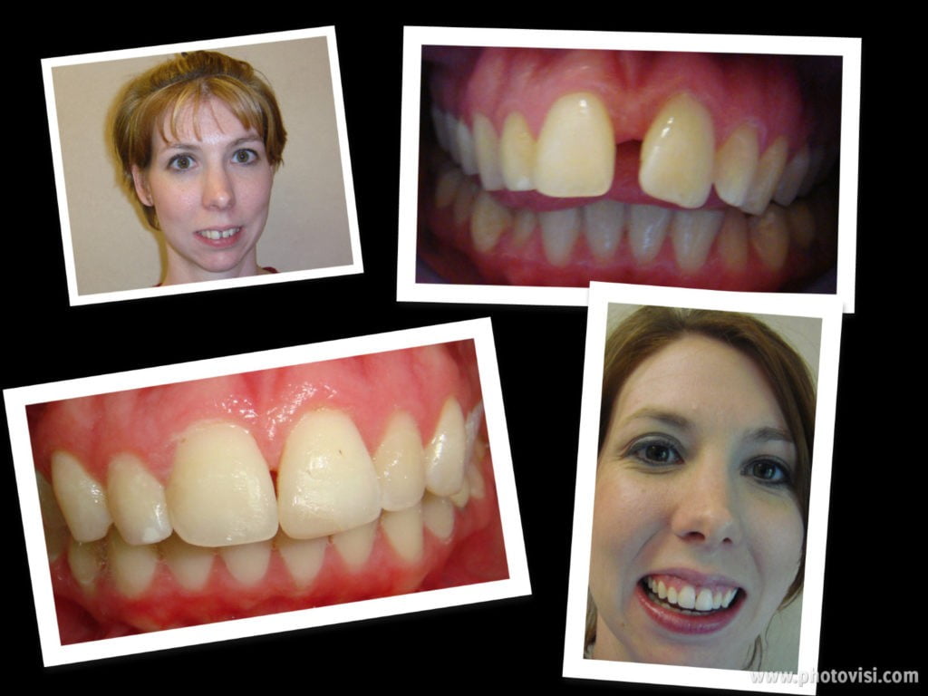 Invisalign Before And After Gallery Advanced Dental Care Quincy Il